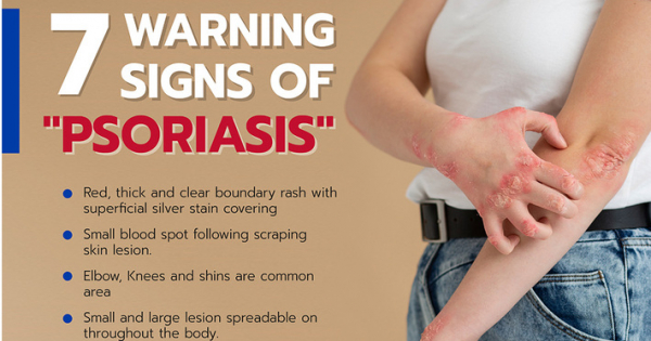 There are seven signs that you have "psoriasis." | Phitsanulok Hospital ...